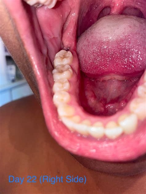 Pictures Of My First 35 Days Of Healing Lower Sockets Extraction Sites