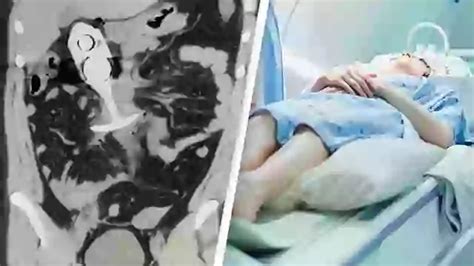 Woman Left Screaming In Pain After Leaving In Sex Toy During Mri Scan