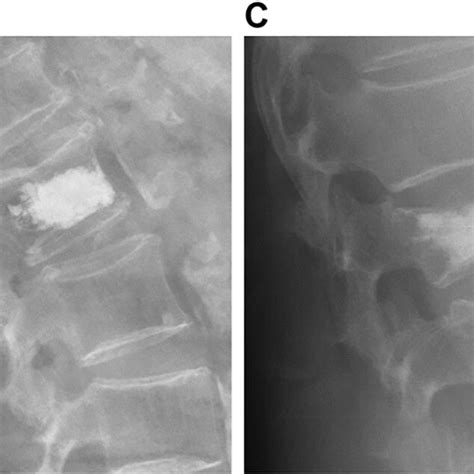 Distribution Of The Type Of Bone Cement A Shape A Bone Cement Is Only