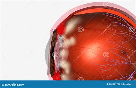 Pars Planitis Is An Eye Disease Where The Middle Layer Of The Eye