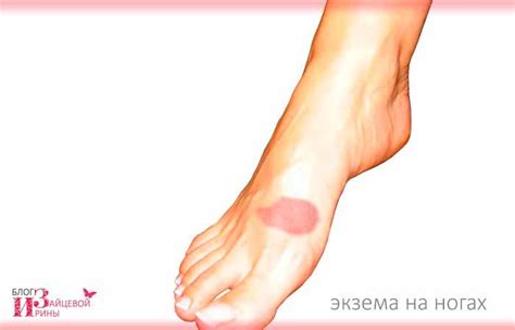 Экзема на ногах Причины и лечение Фото