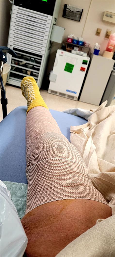 Complex Knee Replacements Dr Shiva Reddy H A