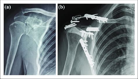 A Chondrosarcoma In Glenoid B Reconstruction With Fresh Frozen Download Scientific Diagram