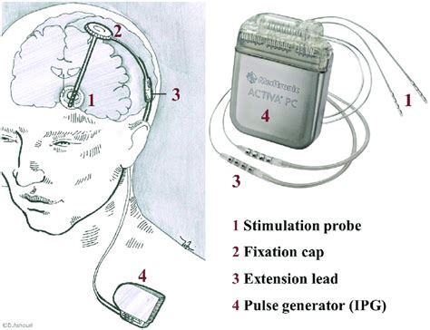 figure 7 an implantable dbs system consists of four components the