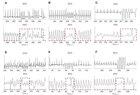 Figure 2 From Training Convolutional Neural Networks On Simulated Photoplethysmography Data