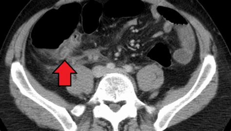 Apendicitis Flashcards
