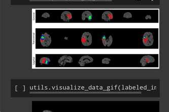 BRAIN TUMOR DETECTION USING MACHINE LEARNING Devpost