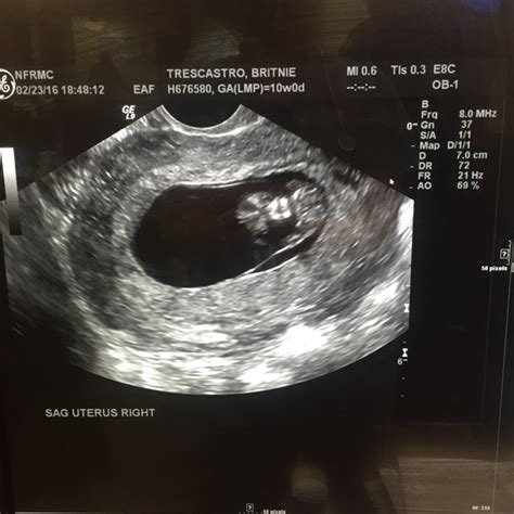10 Week Transvaginal Ultrasound Glow Community