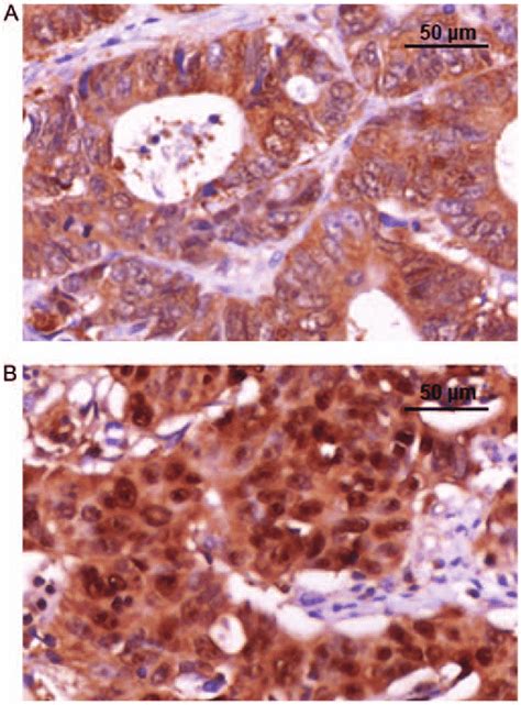 Maspin Subcellular Localization A Cytoplasm Positivity Without