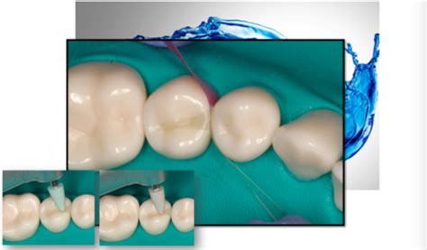 2 2 Operative Class Ii Composite Restorations Flashcards Quizlet