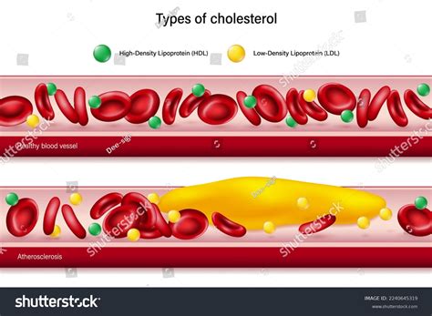 Types Cholesterol Highdensity Lipoprotein Hdl Lowdensity Stock Vector Royalty Free 2240645319