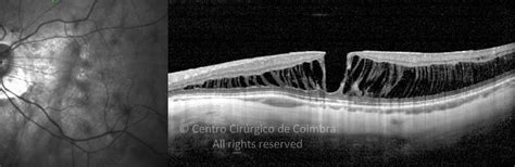 Degenerative Myopia Atlas Rl Eye