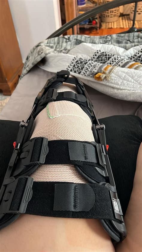 6 Days Post Op Racl