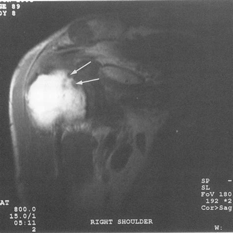 Arthrogram Of The Right Shoulder Download Scientific Diagram