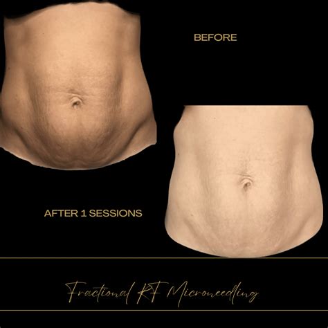 Fractional Radiofrequency Microneedling Beauty Empire 33615