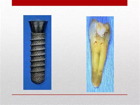 Dental Implants 2 Classification Dr Meenu Merry C Paul Ppt