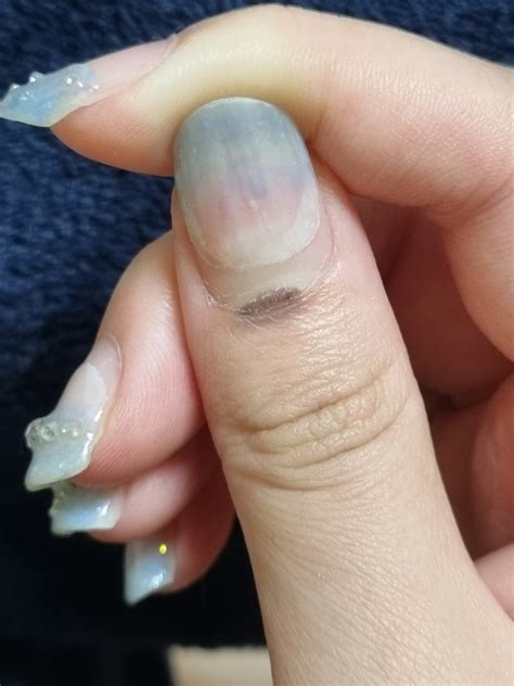 손톱에 검은 점이있는데 많이심각한건가요ㅠㅠ 지식in