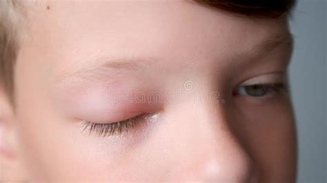 Swollen Face Allergy
