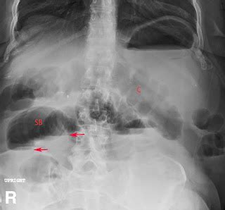 RiT Radiology Air Fluid Levels At Different Heights In The Same Loop Of Bowel