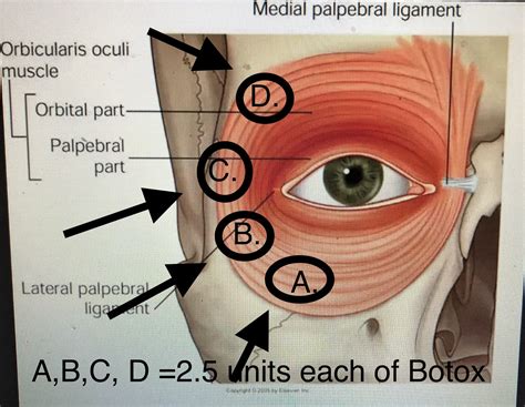 Crows Feet Botox Application For Brow Lift And Those Pesky Crows Feet Lateral And Below Eyes