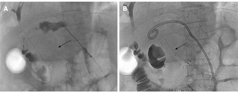 Cholangiogram Obtained After Contrast Injection Through The Access