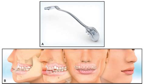 Carriere Class Iii Motion For Skeletal Class Iii