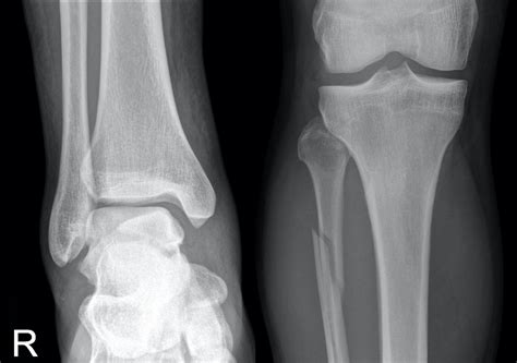 Spiral Fracture Distal Fibula Bastauniversity