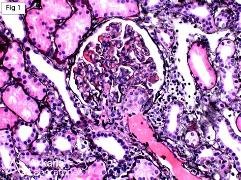 Thrombotic Microangiopathy Teaching Points Arkana Laboratories