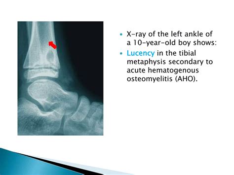 Acute Osteomyelitis Pptx
