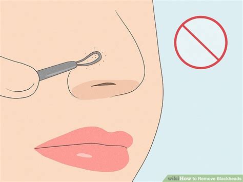 Ways To Remove Blackheads WikiHow