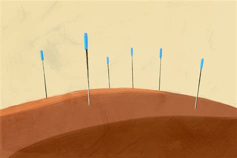 Cosa Sono I Trigger Point E Come Possono Essere Trattati Nike Ch