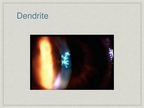 Ppt Trichiasis Powerpoint Presentation Free Download Id3040688