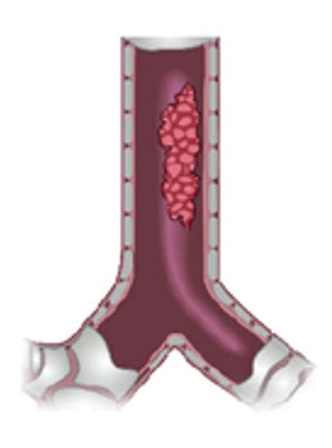 Classification Of Obstructive And Restrictive Diseases Flashcards Quizlet