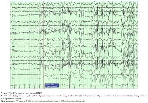 Eeg Fun Facts Non Epileptic Events Jun 14 2024