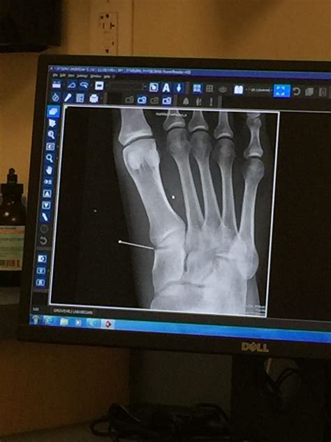 An Incredibly Rare Isolated Medial Cuneiform Fracture That Happened To Me Sunday R Pics