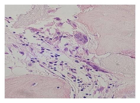 Pathological Findings 1 H E ×40 And 400 Aggregation Of Shadow Cells