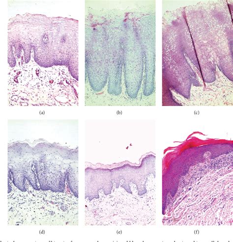 Figure 3 From Oral Lesions Induced By Chronic Khat Use Consist Essentially Of Thickened