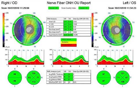 Retinal Nerve Fiber Layer Analysis In Four Quadrants And Eight Sectors Download Scientific