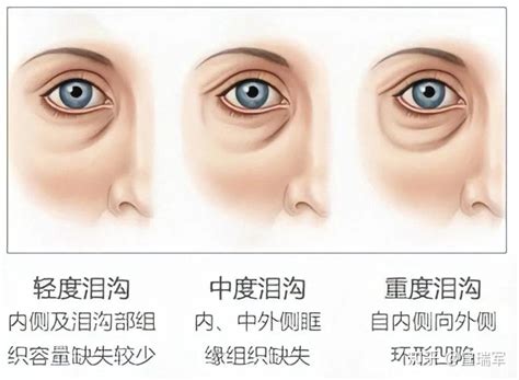 45岁泪沟凹陷要怎么治疗？用这种材料比玻尿酸更安全有效！ 知乎