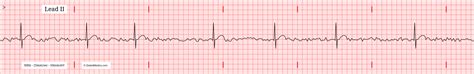 The Atrial Fibrillation Af Ecg Ekg
