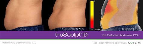 Trusculpt Id The Center For Advanced Dermatology