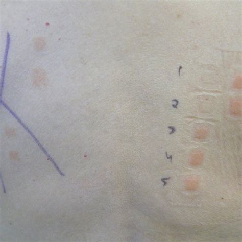 Patch Testing To Dcp After Repeat Sensitization The Right Side Download Scientific Diagram
