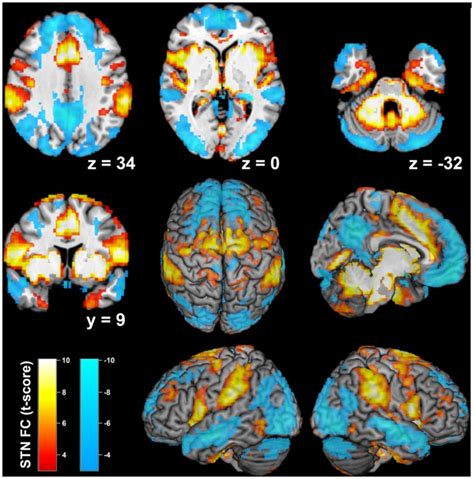 Resting State Functional Connectivity Of The Bilateral Subthalamic