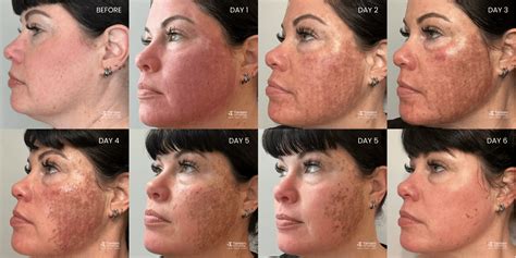Co2 Laser Resurfacing Tareen Dermatology Tareen Dermatology