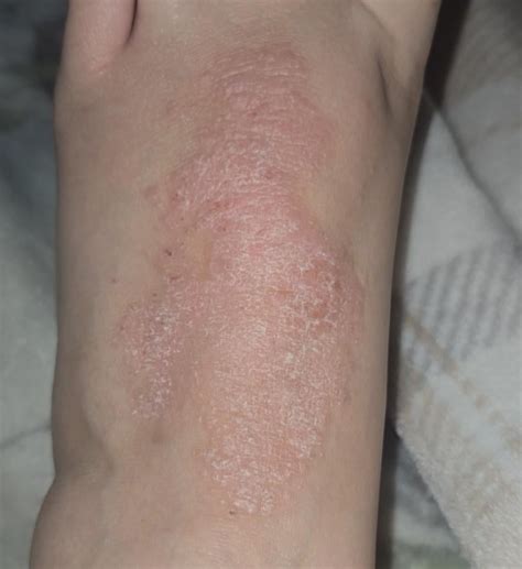 Psoriasis Or Ringworm R Dermatologyquestions