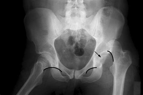 30 Facts About Pipkin Fracture Dislocation