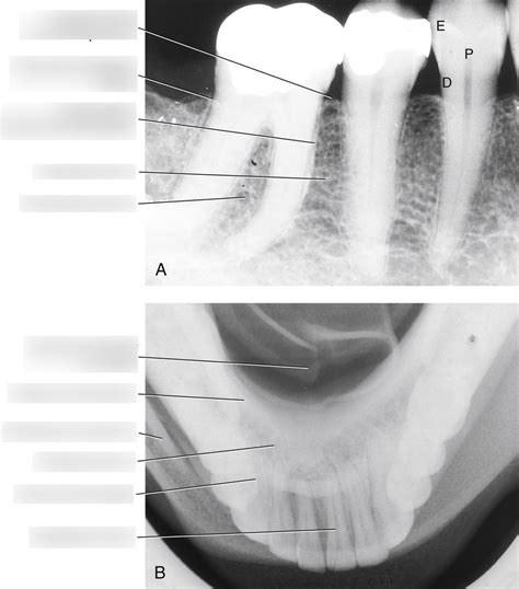 Radiographic Alveolar Process Diagram Quizlet