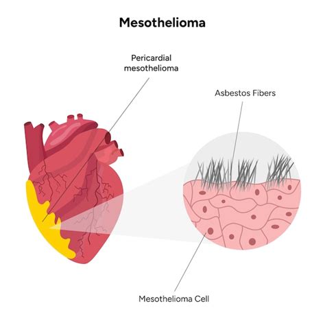 Premium Vector Mesothelioma Pericardial Mesothelioma Zoom
