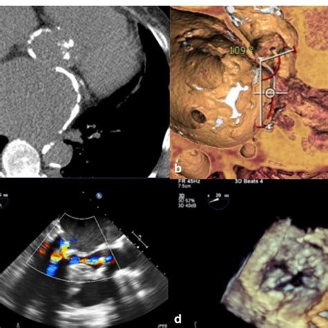 A Pre Operative CT Scan Severe Calcification And Dilation Of Left Download Scientific Diagram