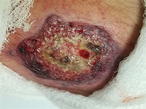 Diagnosis Pyoderma Alomedika
